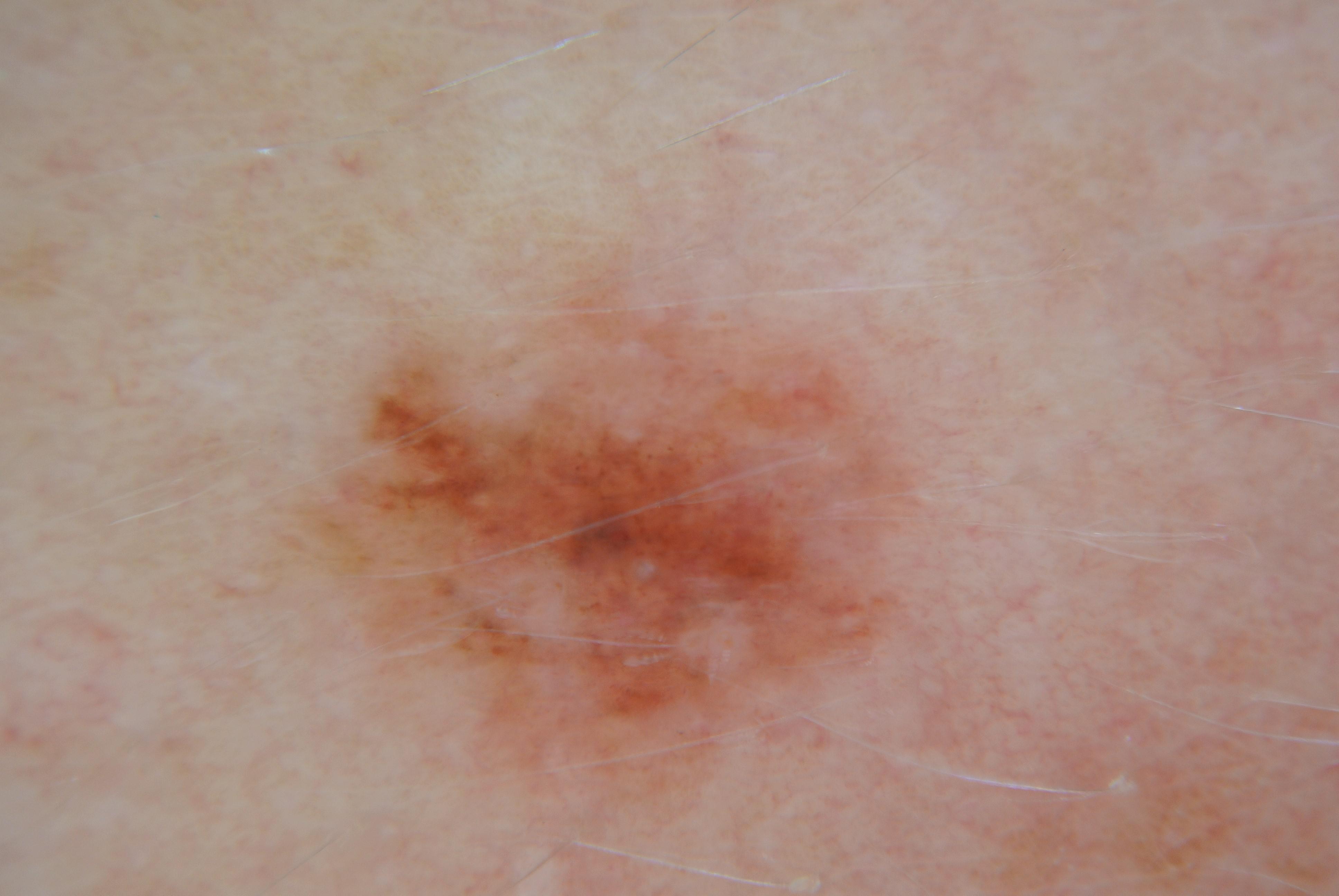 Skin Disease Dataset V2 Object Detection Dataset And Pre Trained Model