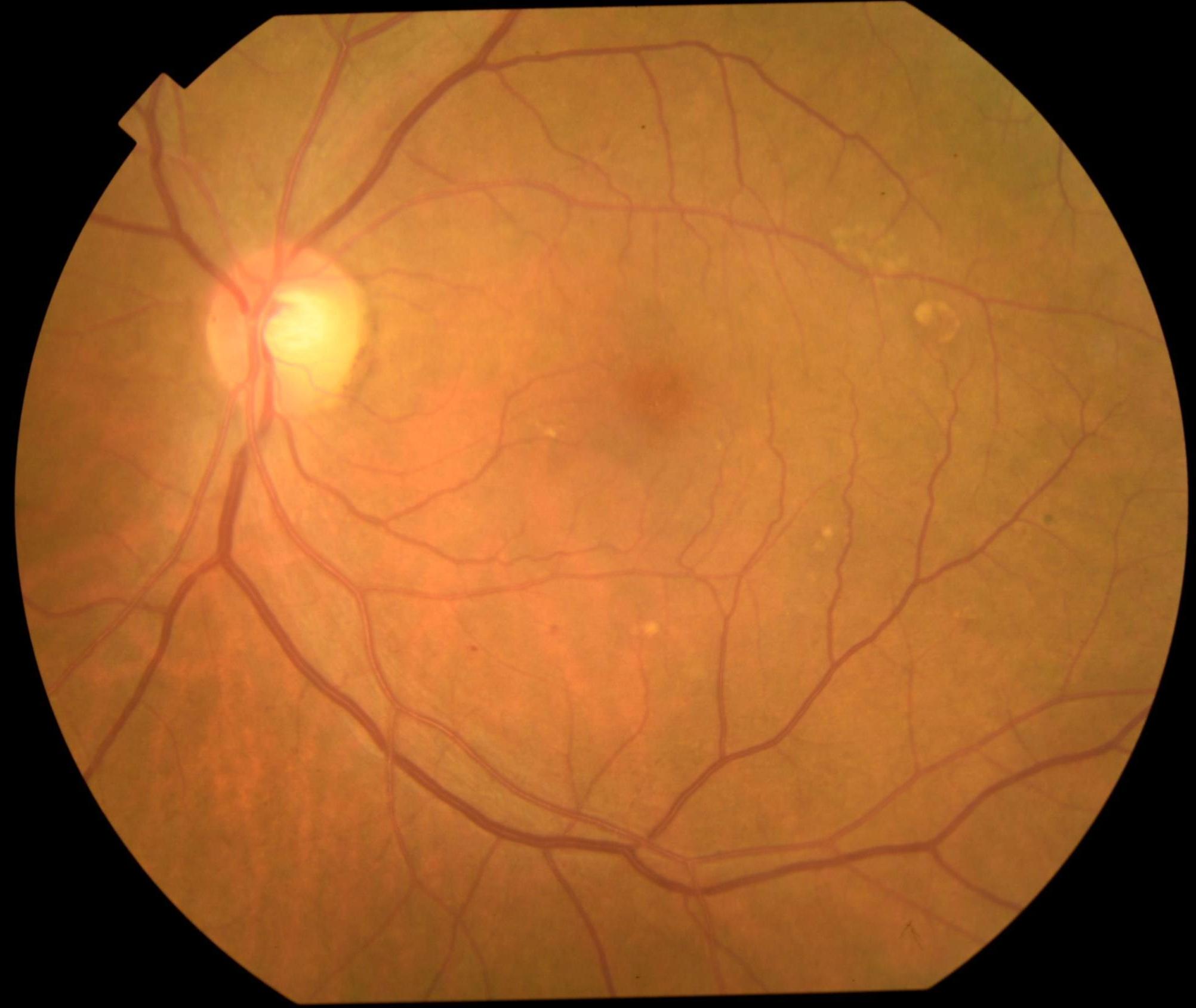 Eyes Desease Dtection Object Detection Dataset By Eyes