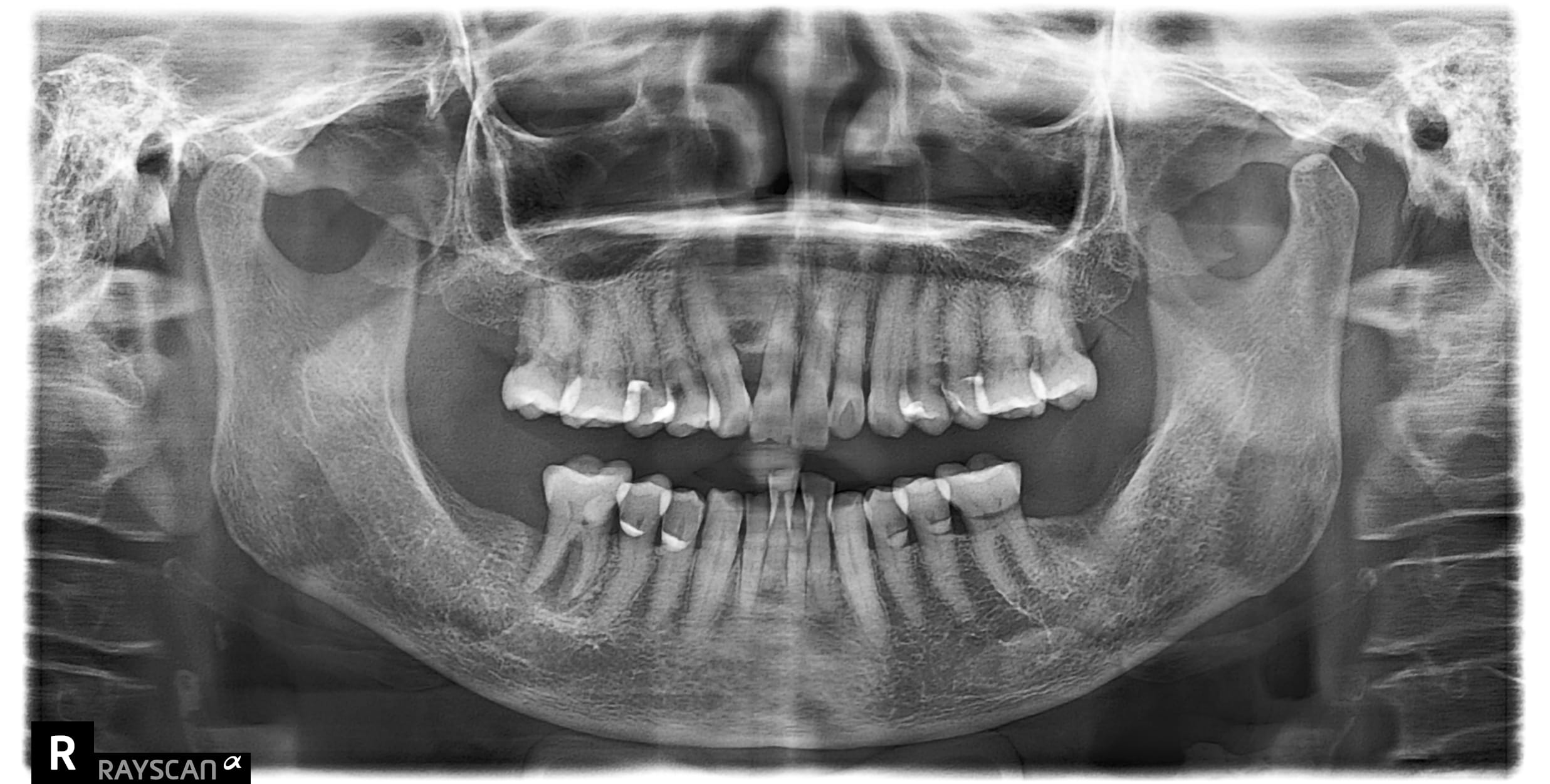 Apical Lesion Detection Object Detection Dataset By Monikas Galaxy