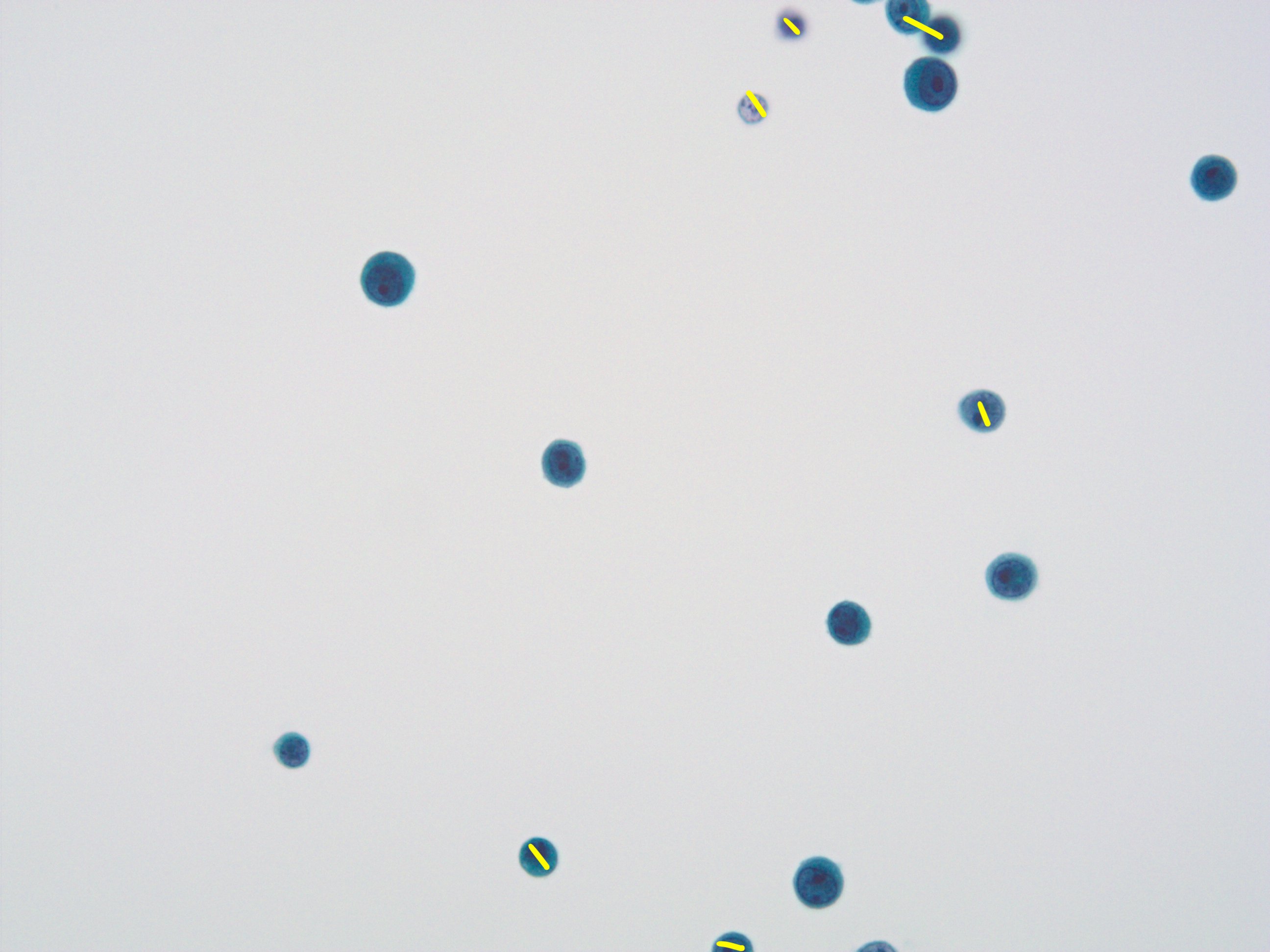 DTT Instance Segmentation Dataset by Cell morphological changes and object detection