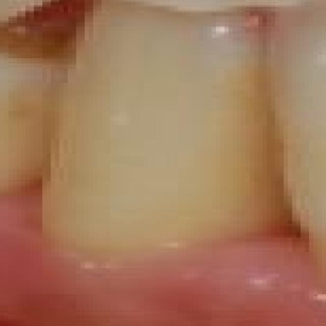 Teeth Disease Dataset Caries Onl Object Detection Dataset By Rizka Milandga