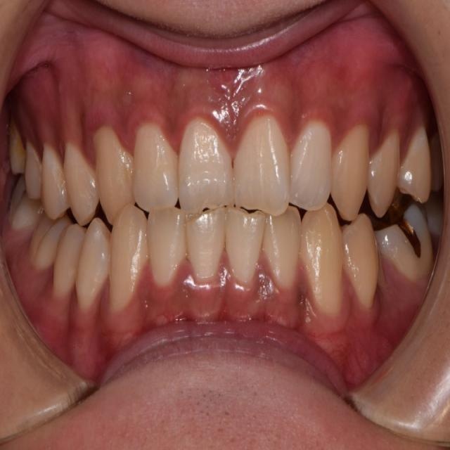 Teeth Numbering Mdl Teeth V3 Object Detection Dataset By Rizka Milandga