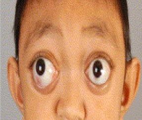 eye-diseases-detect Classification Dataset by Muhammad Giat