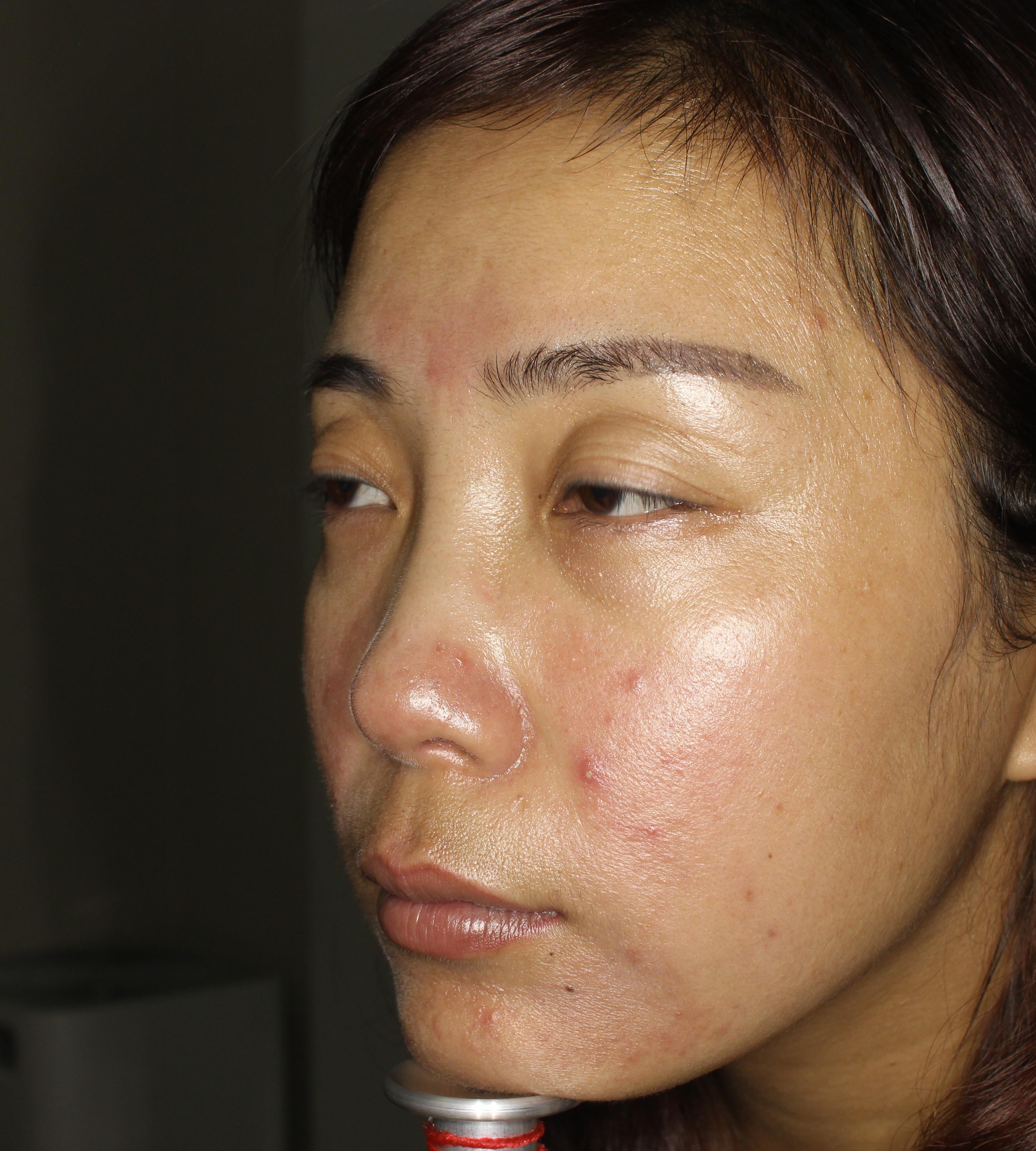 Acne Object Detection Model (v2, 2025-01-28 6:49pm) by Narges