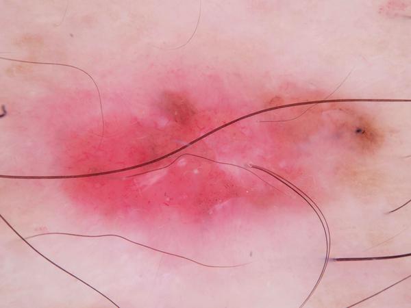Skin Cancer Object Detection Dataset by My Project