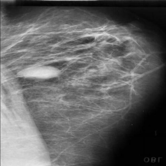 How to Use the breast cancer model Object Detection API