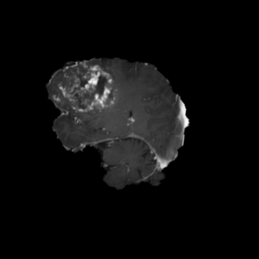Brain Tumour Detection Object Detection Dataset V5 2023 01 11 3 25pm