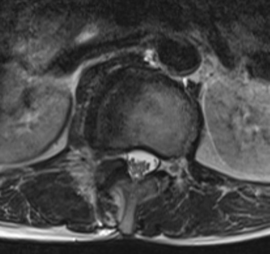 LSS_Lumbar_Spine_Semantic Semantic Segmentation Model by 1