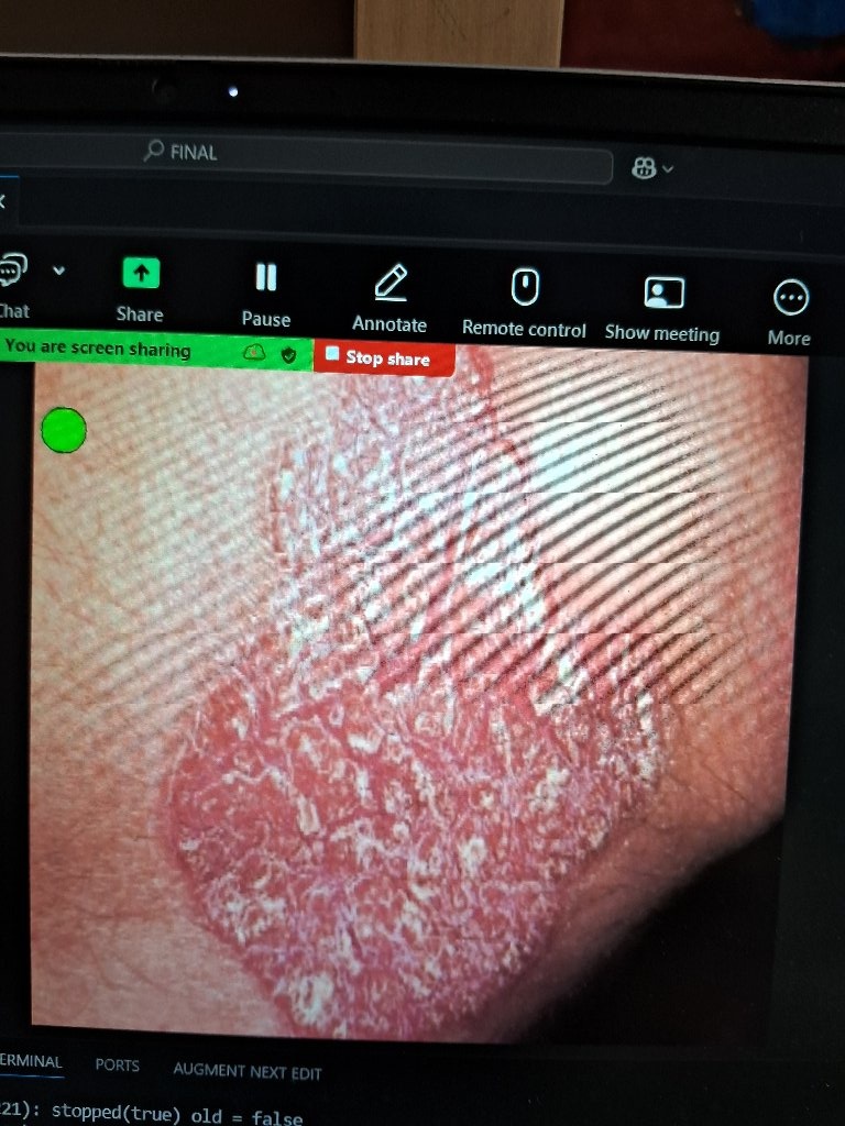 Psoriasis Dataset-2 Instance Segmentation Model by Skinsight