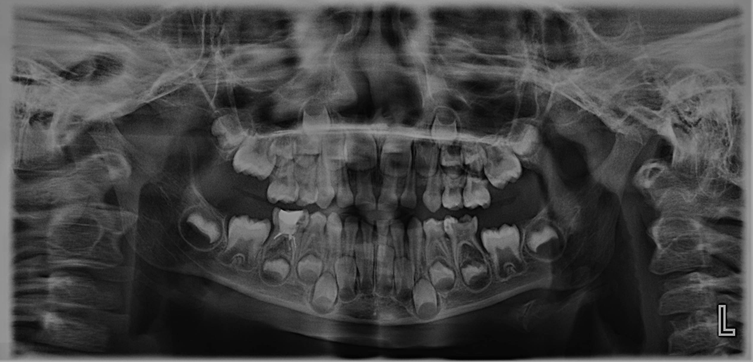 Full Dental Object Detection Dataset By Ozudental