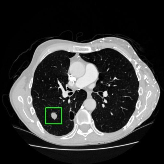 lung_training Object Detection Dataset by Canser