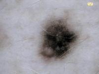 Skin Lesion Masking - Roboflow Universe