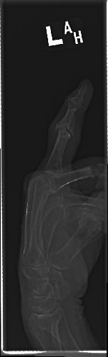 Bone Fracture Detection Object Detection Dataset And Pre Trained Model