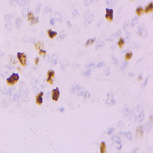 cancer cell Object Detection Dataset by Ahills Workspace