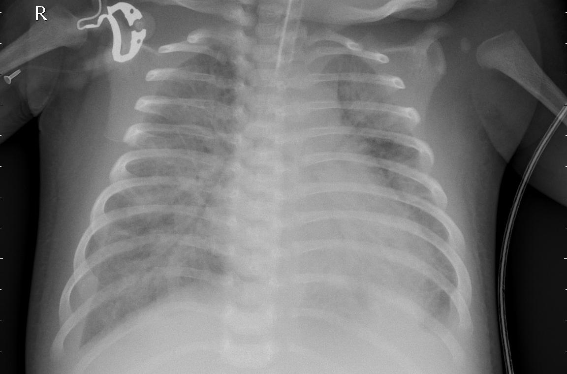 Chest Xray Classification Dataset by yolo