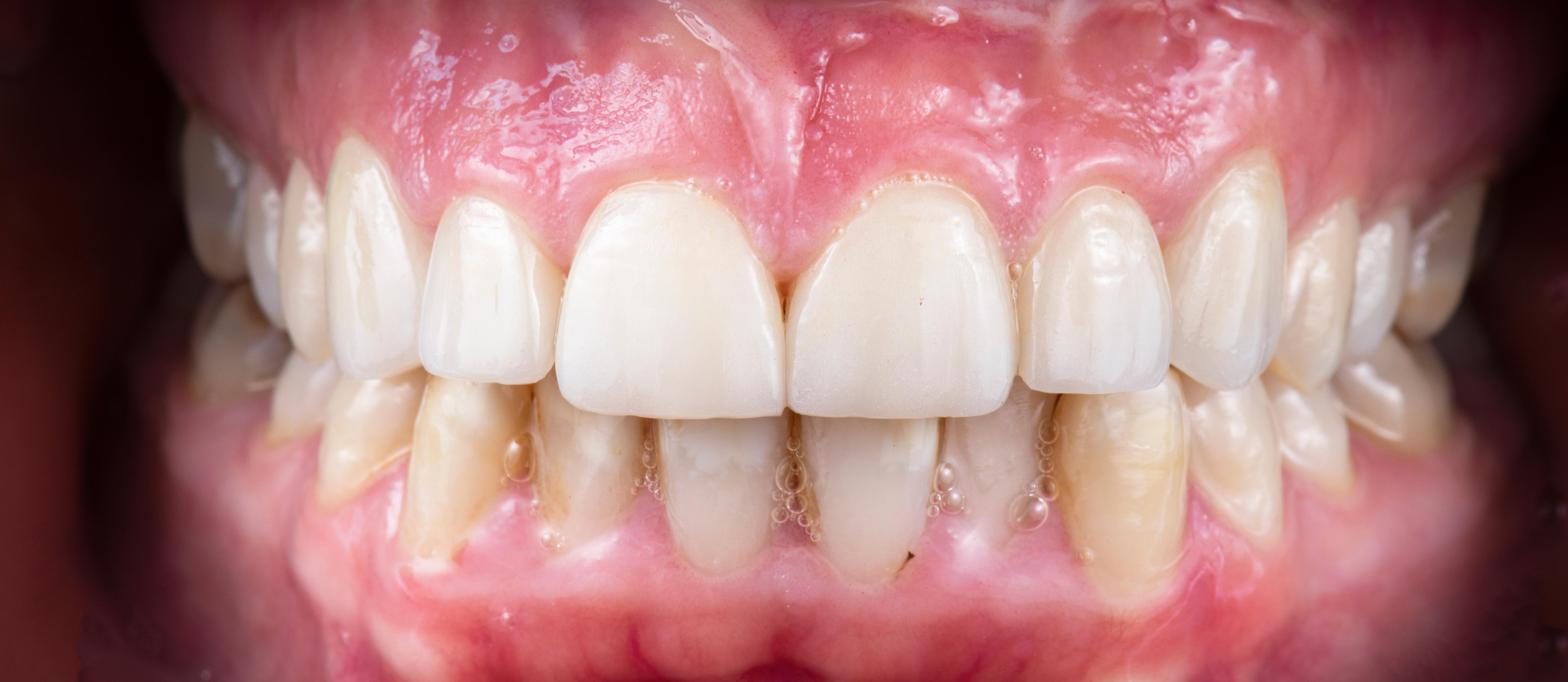 AI In Dentistry 3 Instance Segmentation Dataset and Pre-Trained Model by caries