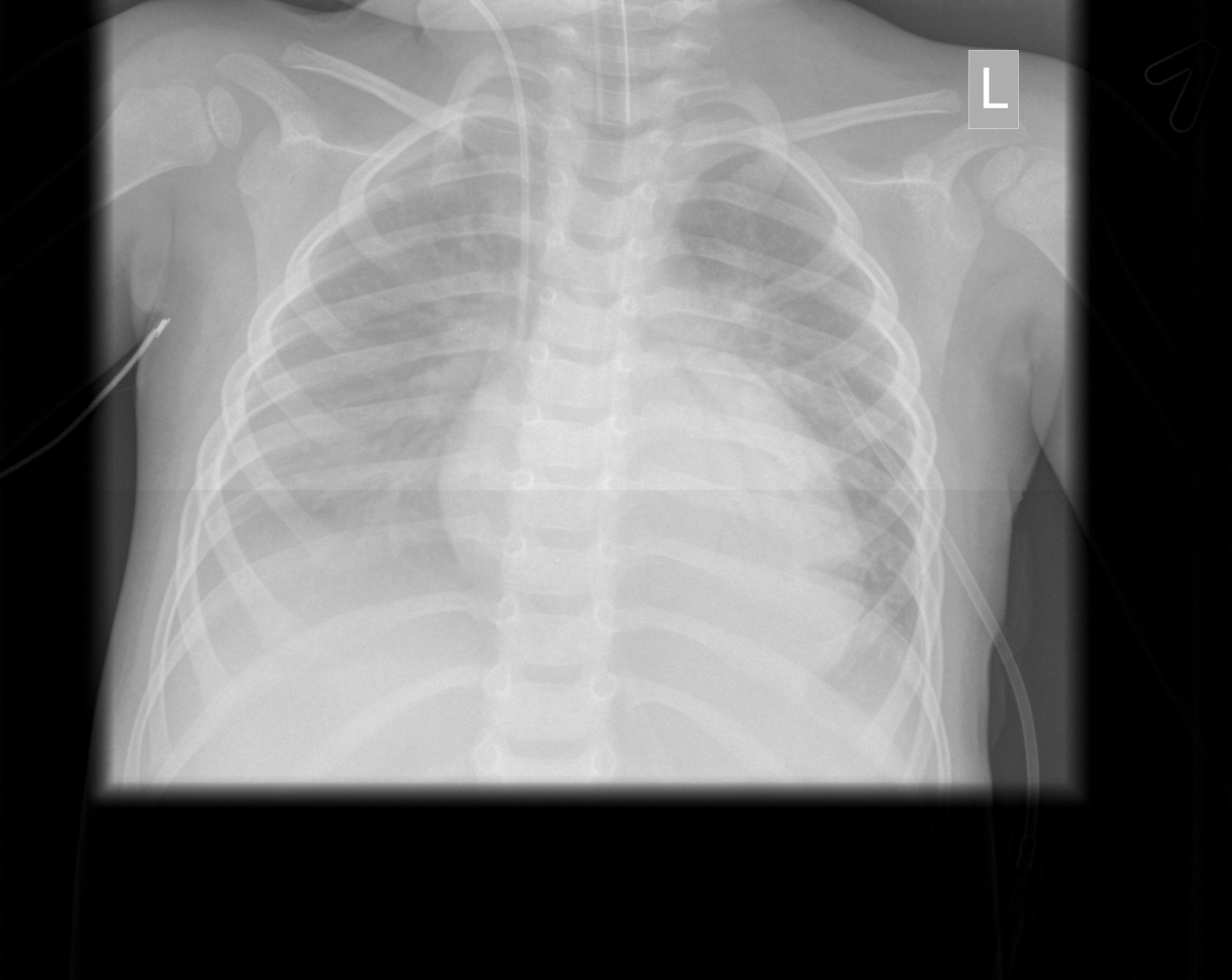 Chest X-ray - 17 Diseases Classification Dataset by EHealthIA