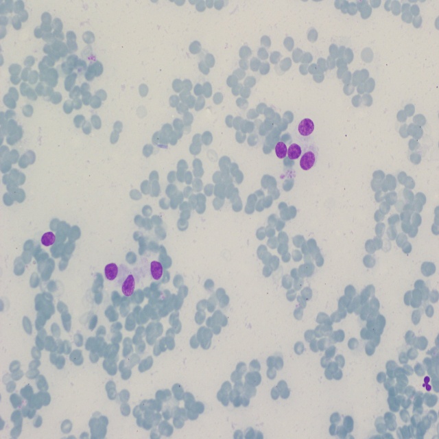 tiroid_papiller Instance Segmentation Model by tiroidpapiller