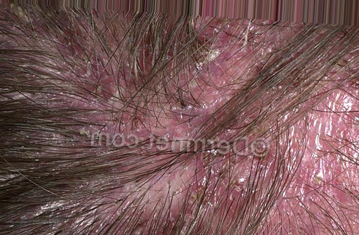 hair scalp analysis Object Detection Model by APP AURA CURL