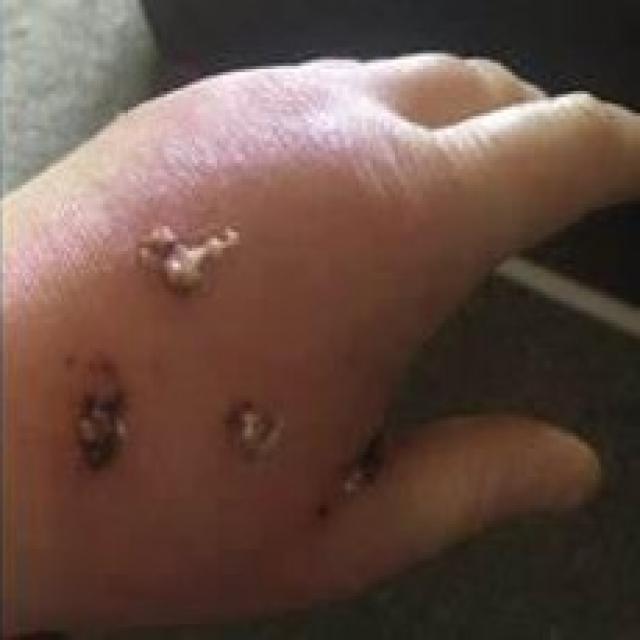 wound detection Classification Dataset and Pre-Trained Model by leslieornot