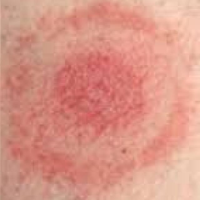 rashes Object Detection Dataset by NPO