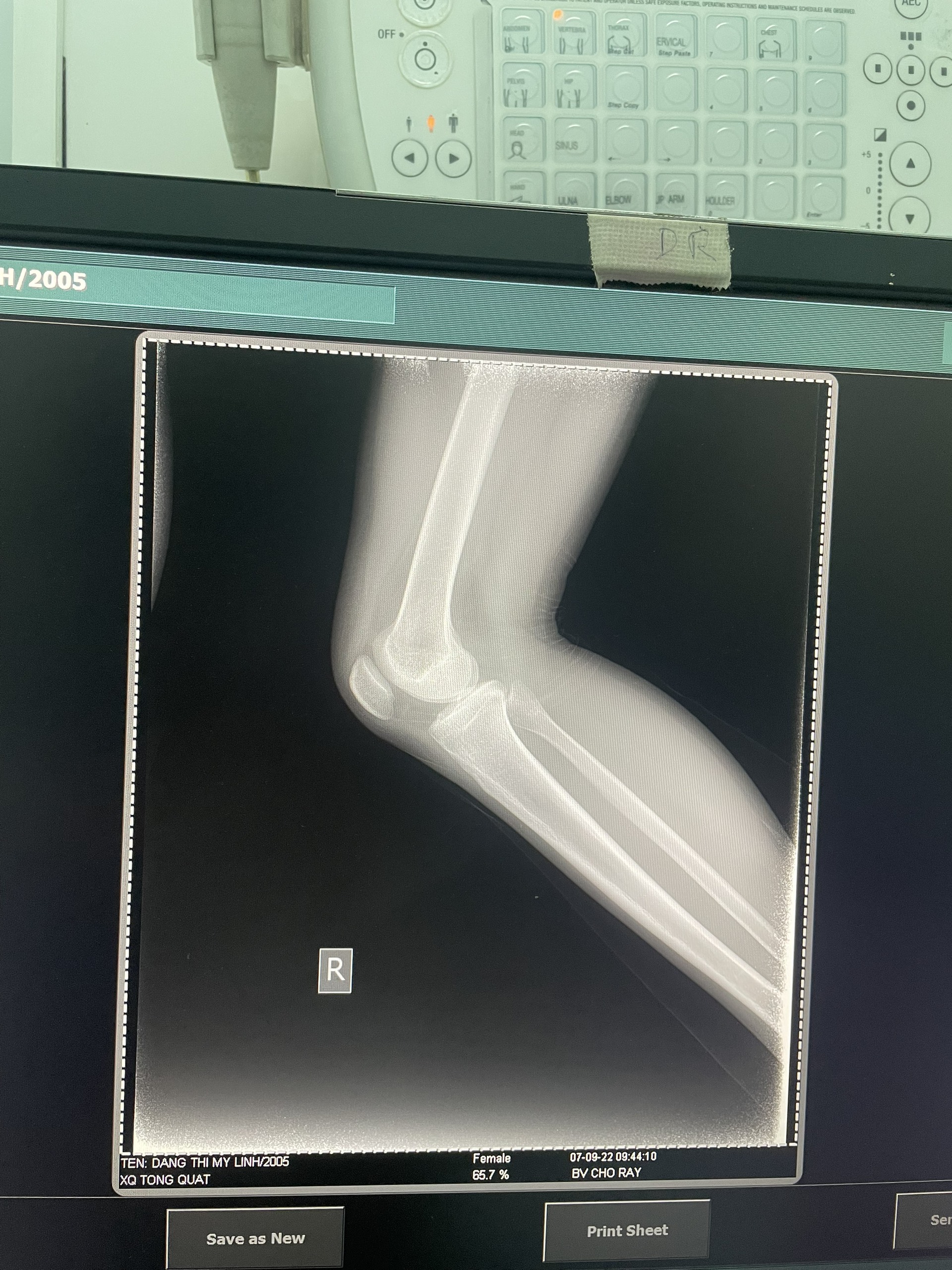 knee joint x-ray detection Object Detection Dataset by KL