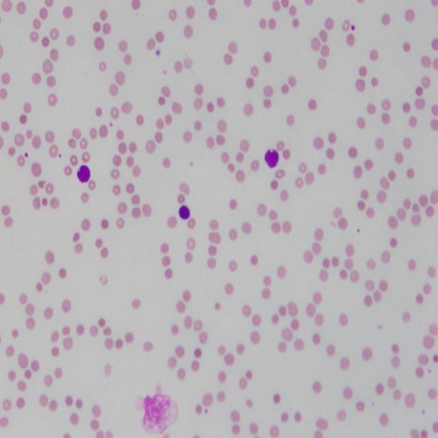 leukemia Instance Segmentation Dataset by Suman computer vision
