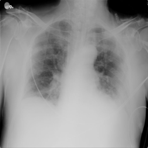lung-radiography-final Object Detection Dataset by Pneumoniame