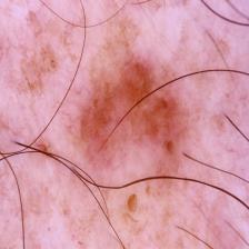 Skin Cancer Detection Classification Model by North South University