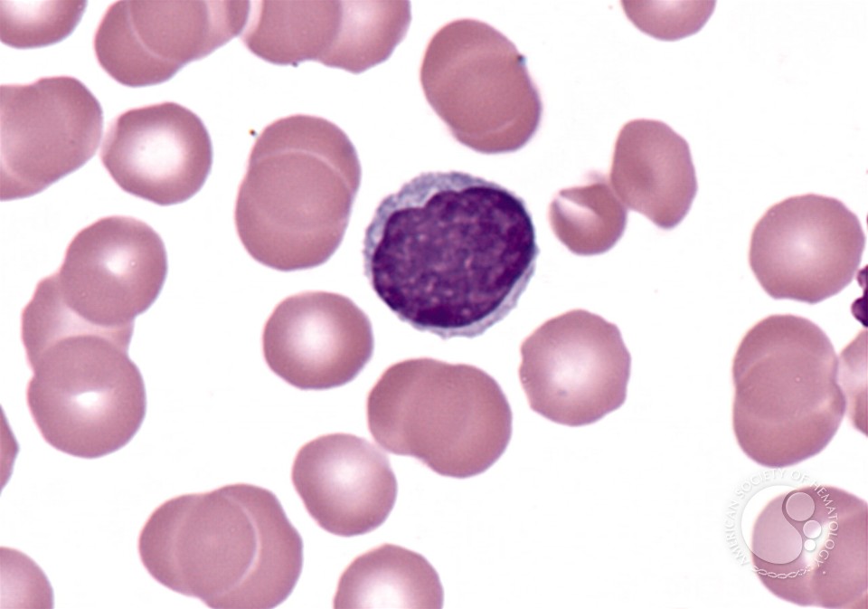 Leukemia Object Detection Model by Soujanya Ghosh