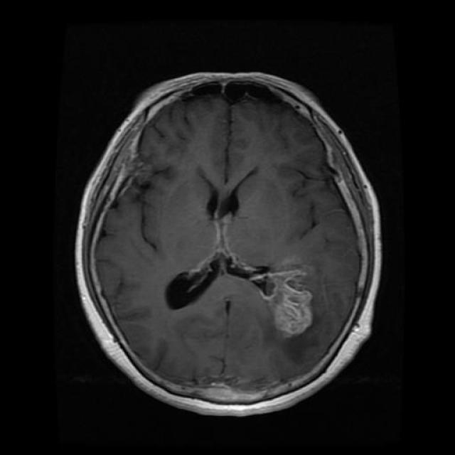 brain-tumor-segmentation Instance Segmentation Model by Fauzia Shofianti