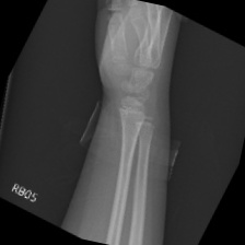 Bone Fracture Object Detection - Roboflow Universe