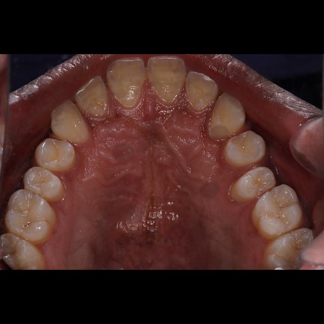 Occlsal Ortho Ai Object Detection Dataset And Pre Trained Model By Mgr Cde Ai