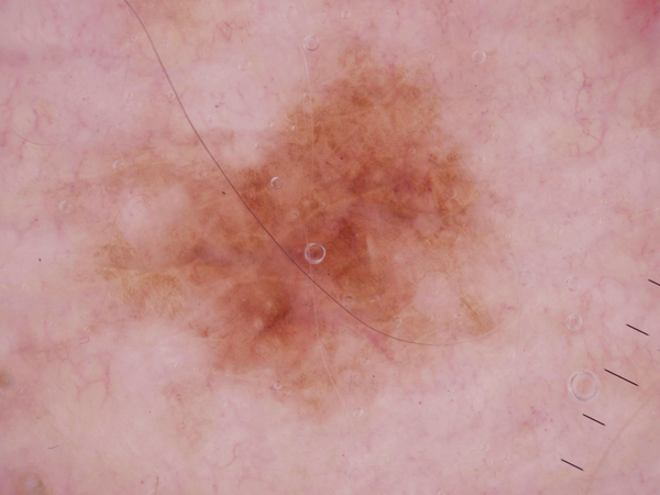 Skin Cancer Segmentation Semantic Segmentation Dataset and Pre-Trained Model by Skin Cancer 4th ...