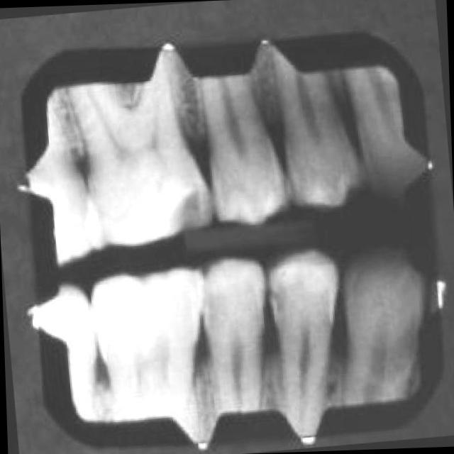 Tooth decay dectection Object Detection Dataset by test