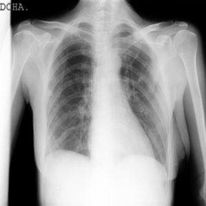 Lung Segmentation Object Detection Dataset by Mask RCNN