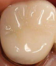 Caries Detection Classification Model by KlogTeethnew