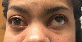 strabismus-detector Object Detection Model by eyes