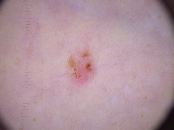 skin cancer Classification Dataset and Pre-Trained Model by Sujit