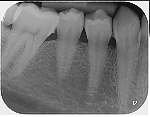 tooth Object Detection Dataset and Pre-Trained Model by sally
