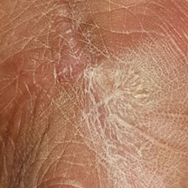 Foot Ulcer Detection Object Detection Dataset V2 2022 11 22 9 59pm