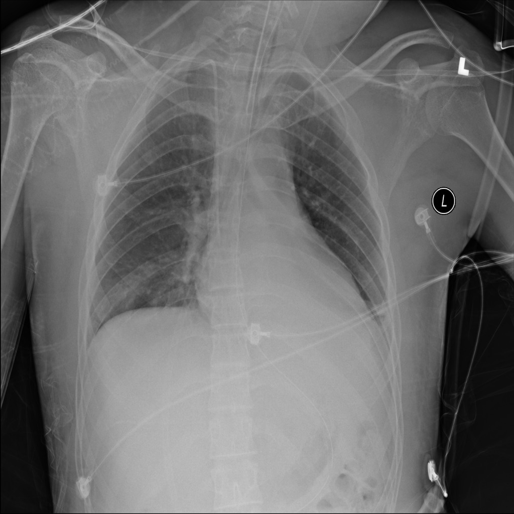 Pneumonia Detection Full Dataset Object Detection Dataset V1 V1 By