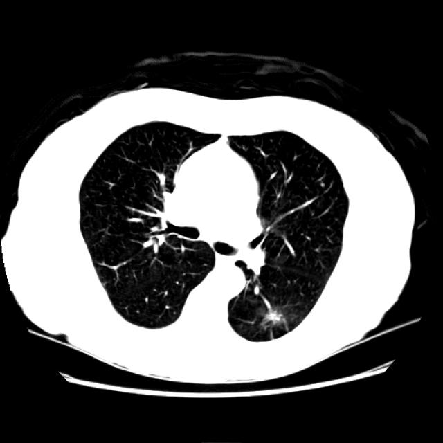 Lung Cancer Dataset Object Detection Model V4 Sclc Inceptionv3 By Tsebad