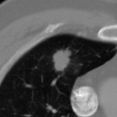 object detection lung - Roboflow Universe