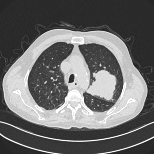 Object Detection Lung Roboflow Universe