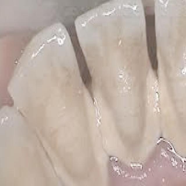 calculus2 Object Detection Dataset by imageprocesessing