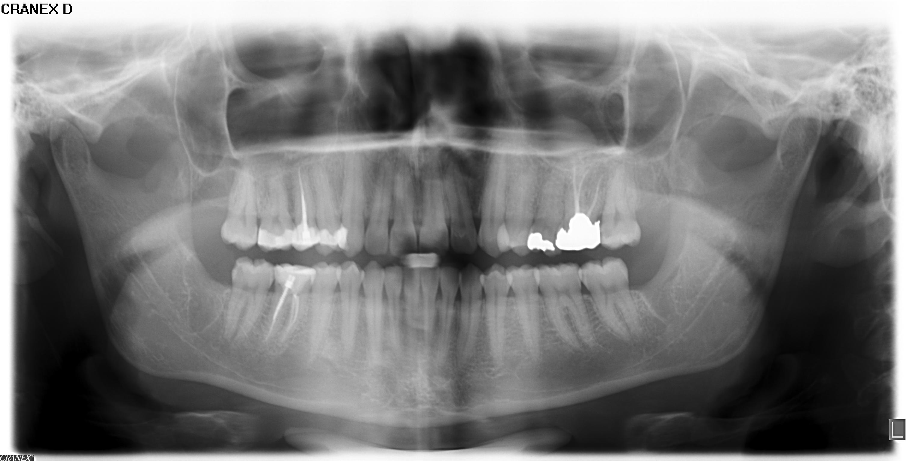 end teeth Object Detection Dataset and Pre-Trained Model by colleg