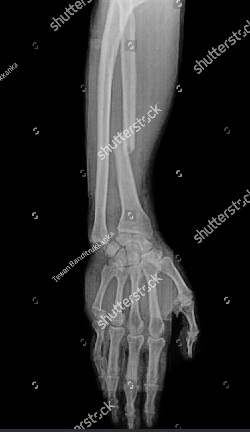 human bone fracture detection Object Detection Model by mytasks