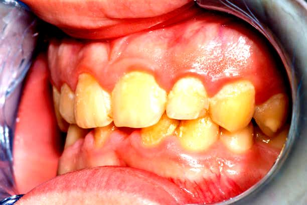 Task 1 Object Detection Model By Oraldiseasedetection
