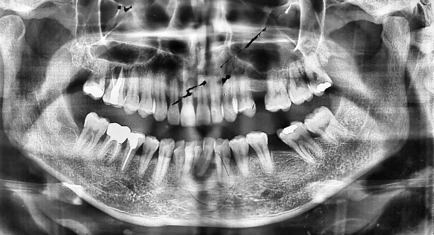 Caries-Dental-Class-Dataset-3 Computer Vision Dataset by Fractured ... Caries-Dental-Class-Dataset-3 Computer Vision Dataset by Fractured ...